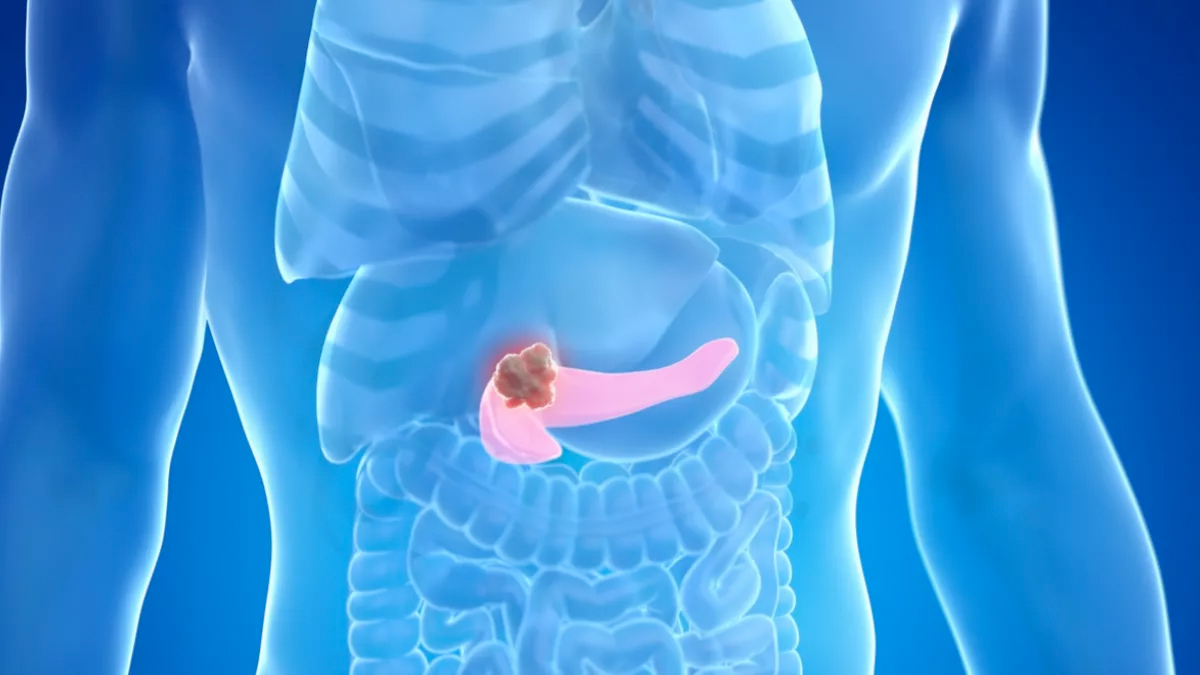 3 Pancreatic cancer problems and how to solve them - All about Graviola